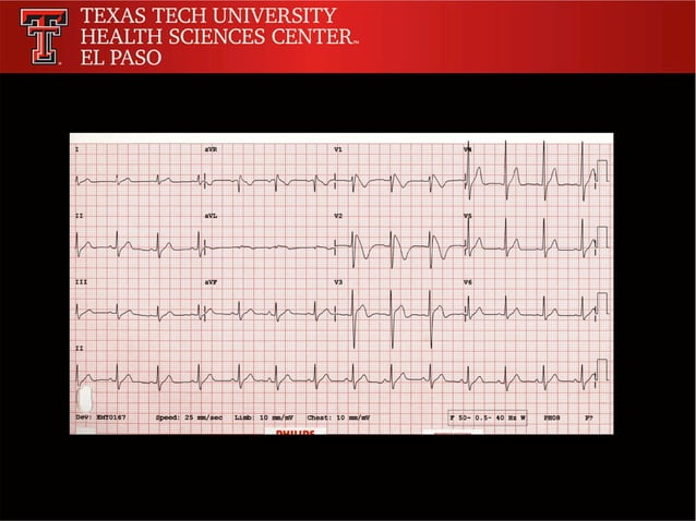 EKG Patterns of SCD - Can't Miss EKG Patterns for Generalist ...