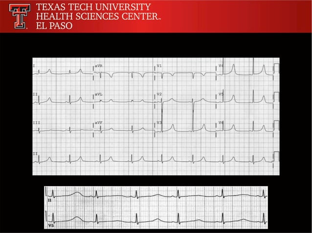 EKG Patterns of SCD - Can't Miss EKG Patterns for Generalist ...
