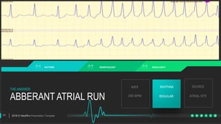 Ekgskillspractice artifact vs ectopy | PPTX