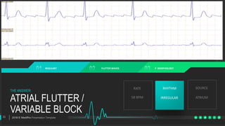 Ekgskillspractice atrial arrhythmias | PPT