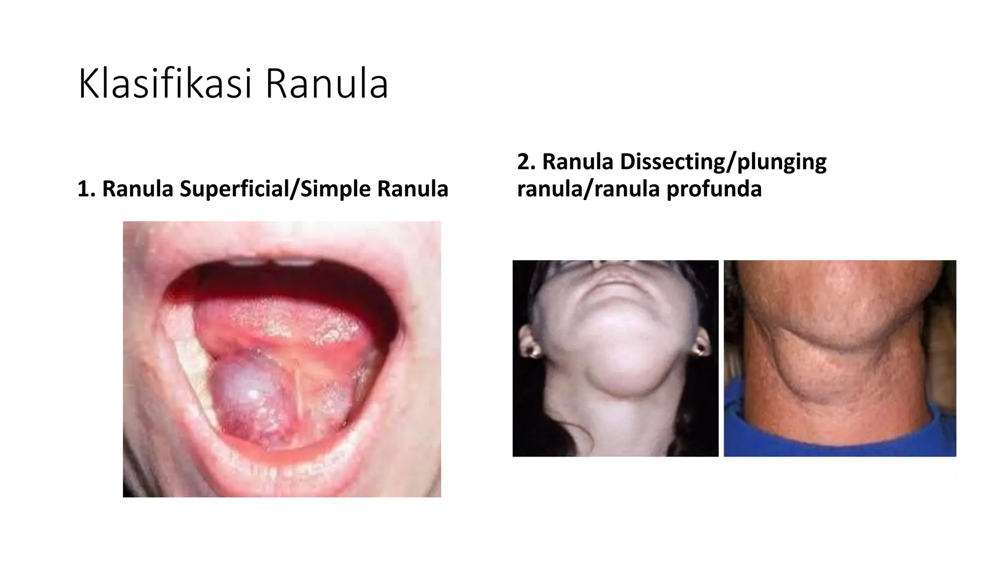 Tatalaksana Eksisi dan Marsupialisasi Ranula.pptx