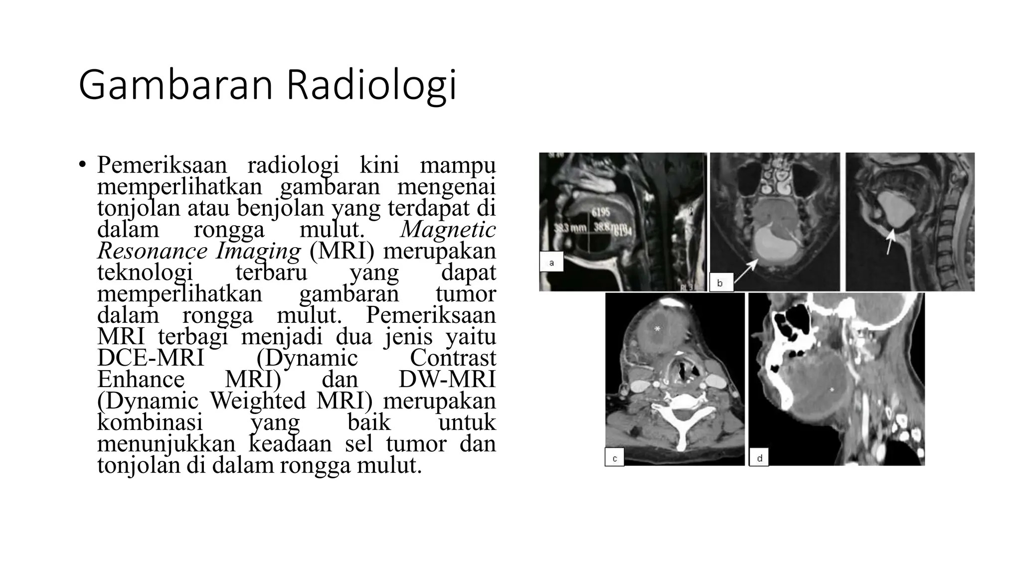 Tatalaksana Eksisi dan Marsupialisasi Ranula.pptx