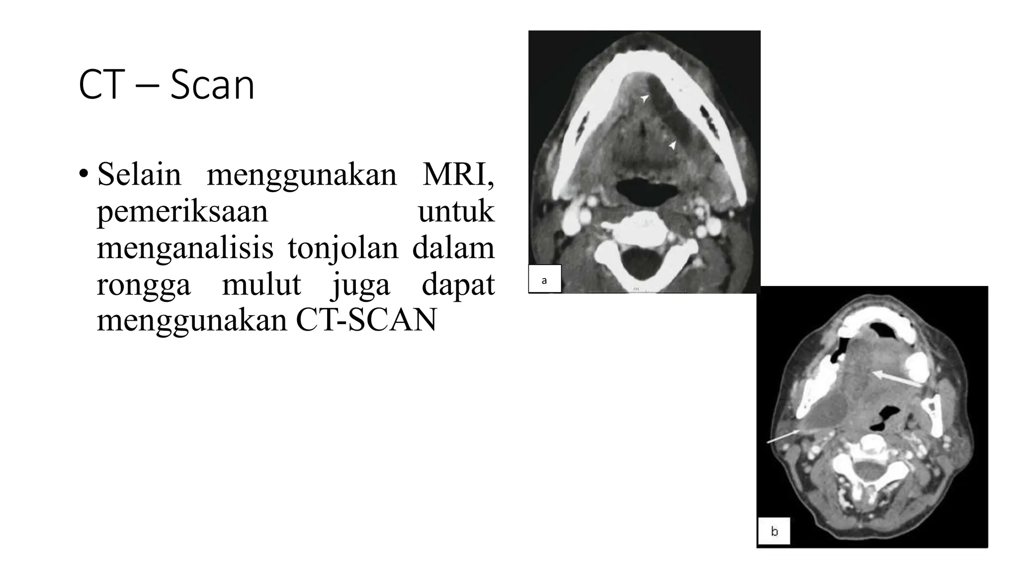 Tatalaksana Eksisi dan Marsupialisasi Ranula.pptx