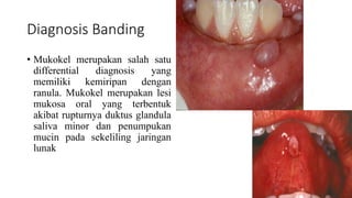 Tatalaksana Eksisi dan Marsupialisasi Ranula.pptx