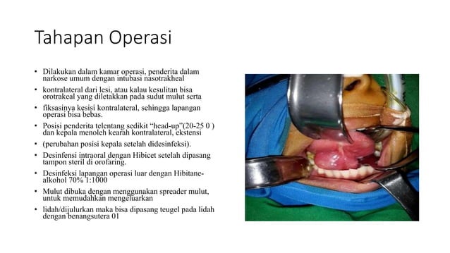 Tatalaksana Eksisi dan Marsupialisasi Ranula.pptx