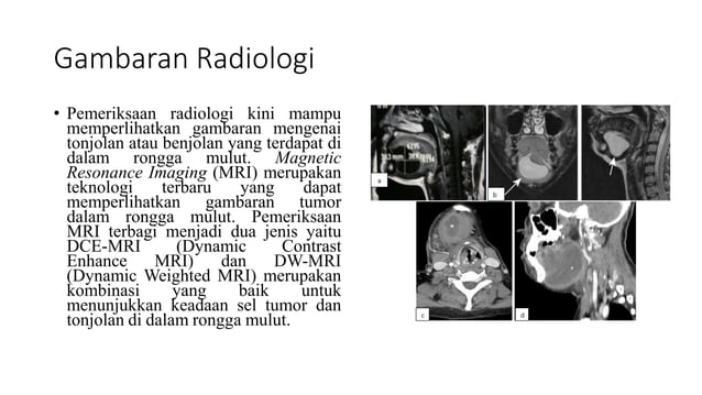 Tatalaksana Eksisi dan Marsupialisasi Ranula.pptx