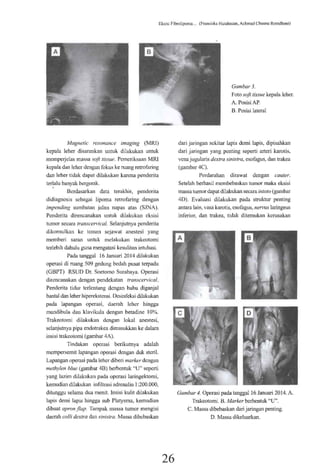 Eksisi fibrolipoma retrofaring dengan pendekatan transcervical laporan ...