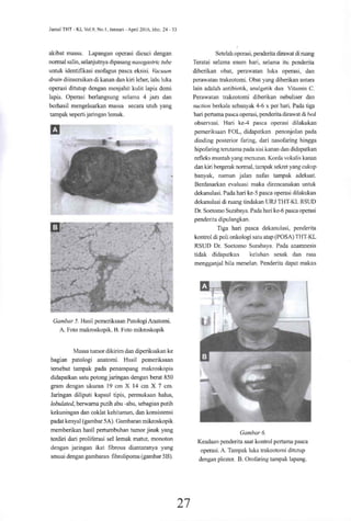 Eksisi fibrolipoma retrofaring dengan pendekatan transcervical laporan ...