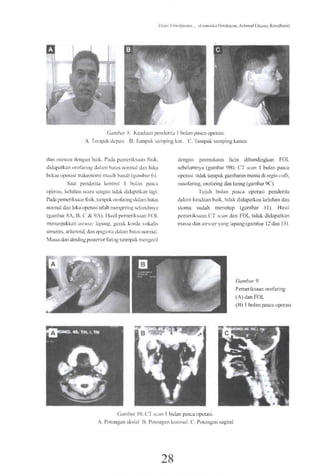 Eksisi fibrolipoma retrofaring dengan pendekatan transcervical laporan ...