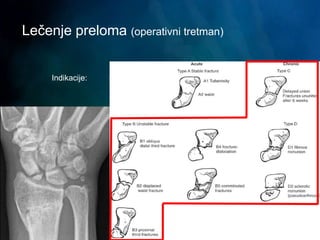 Lečenje preloma skafoidne kosti | PPT