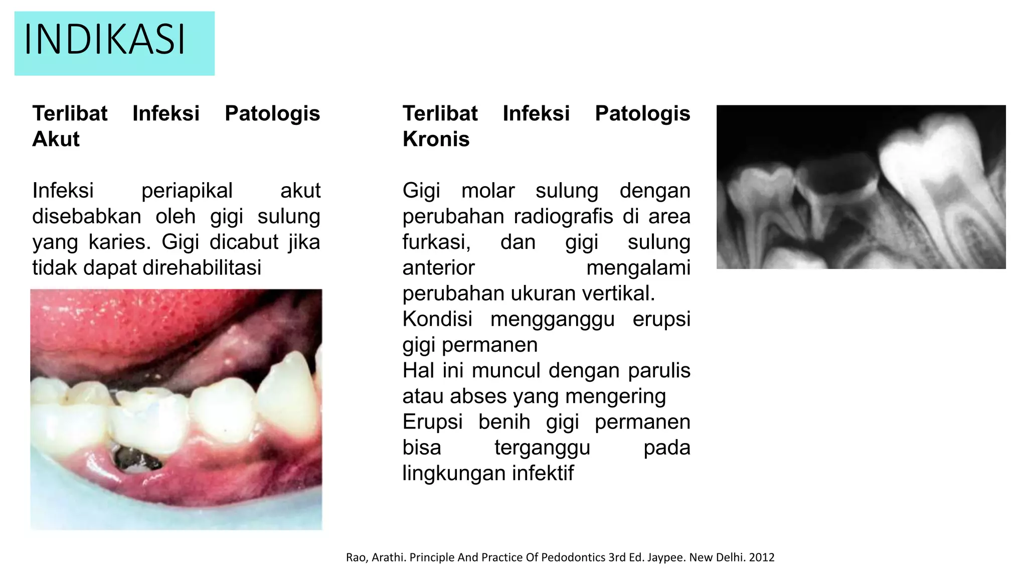 EKSTRAKSI GIGI SULUNG.pptx