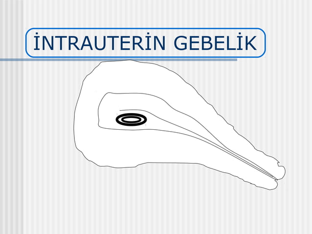 Ektopik usg-2009 | PPT
