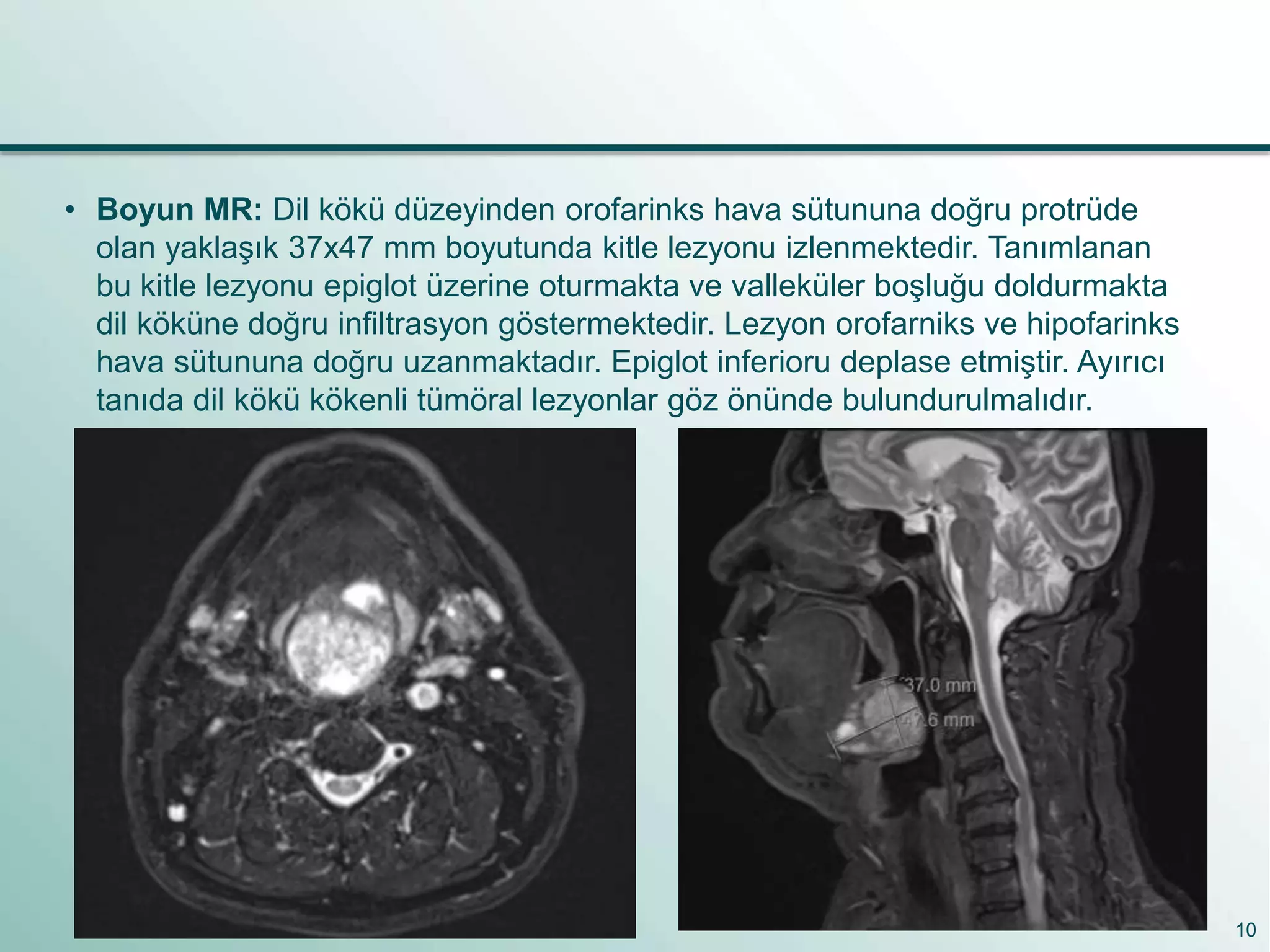 Ektopik Lingual Tiroid.pptx