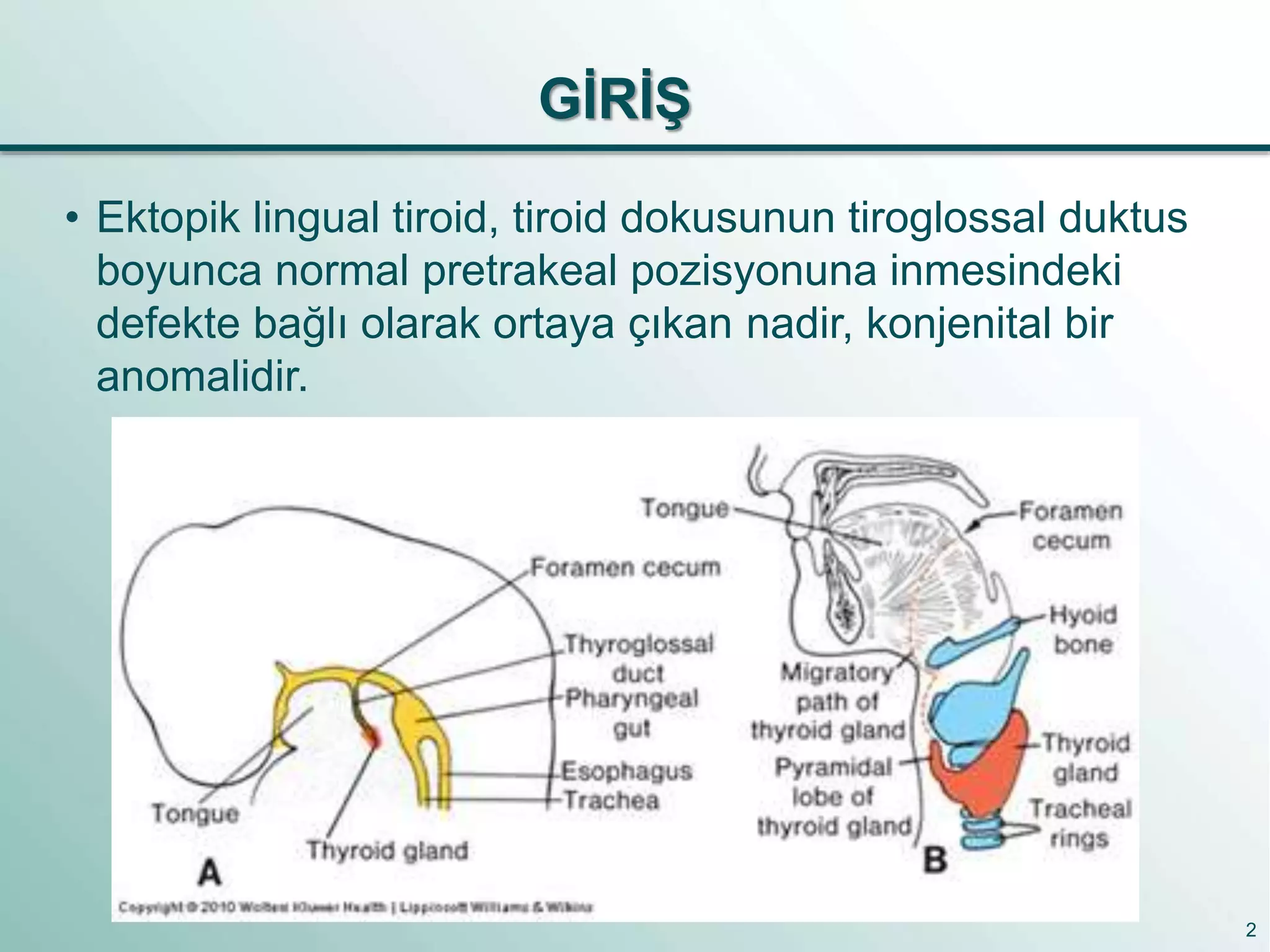 Ektopik Lingual Tiroid.pptx