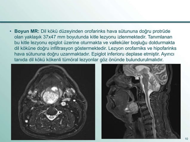 Ektopik Lingual Tiroid.pptx