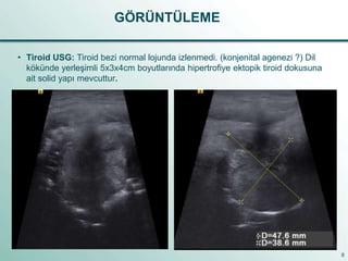 Ektopik Lingual Tiroid.pptx