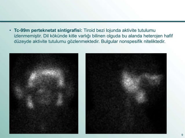Ektopik Lingual Tiroid.pptx