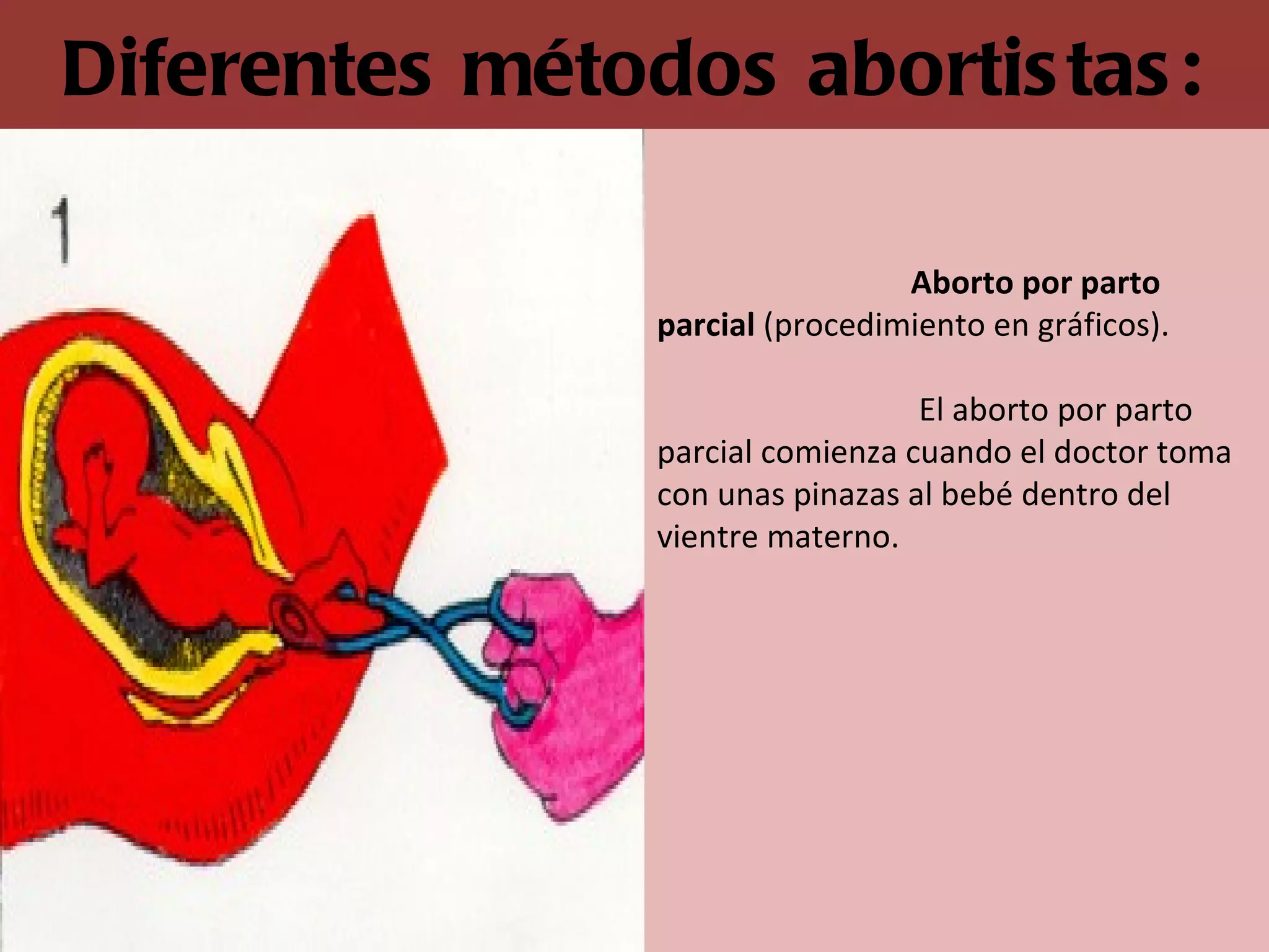 El aborto (presentación diapositivas) | PPT