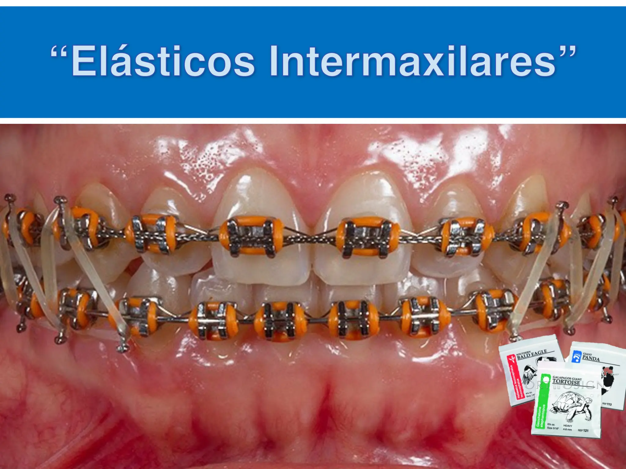 Elásticos Intermaxilares.pdf
