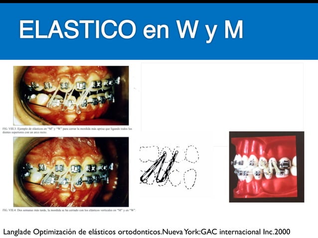 Elásticos Intermaxilares.pdf
