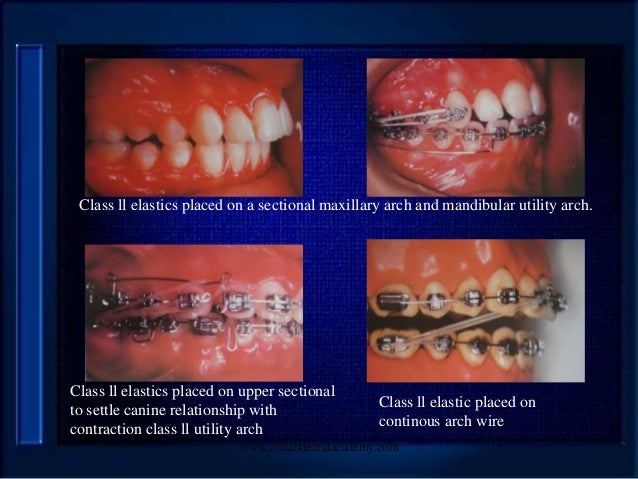 Elastics in orthodontics /certified fixed orthodontic courses by Indi…
