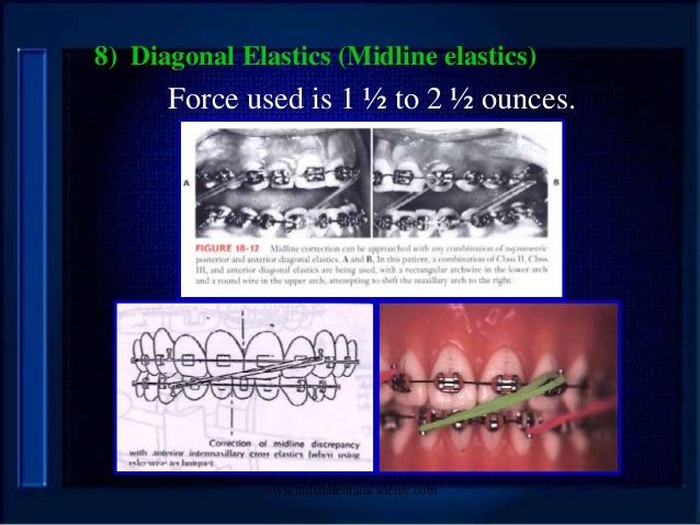 Elastics in orthodontics /certified fixed orthodontic courses by Indi…