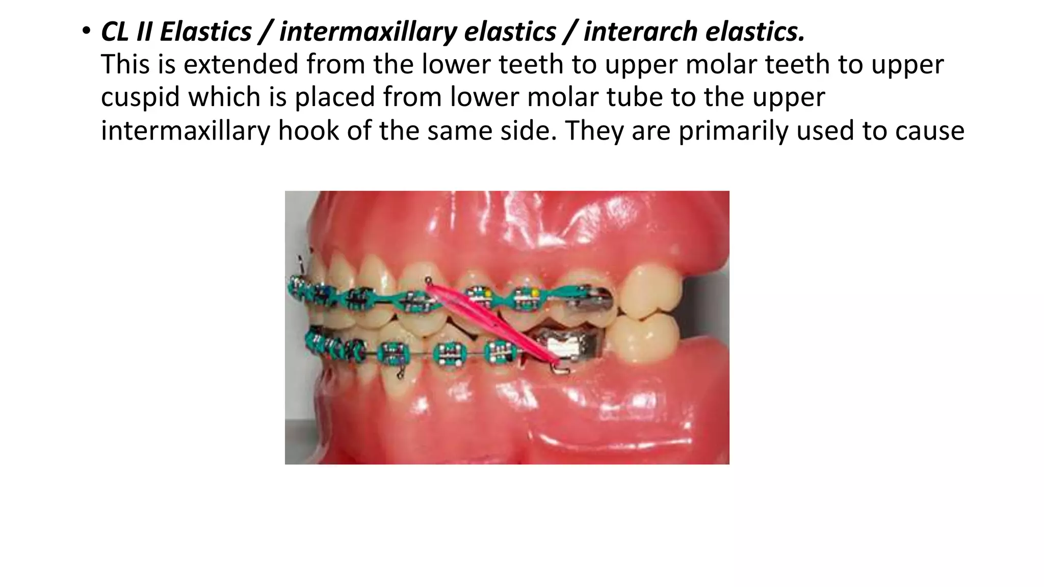 Elastics in Orthodontics -part I | PPTX