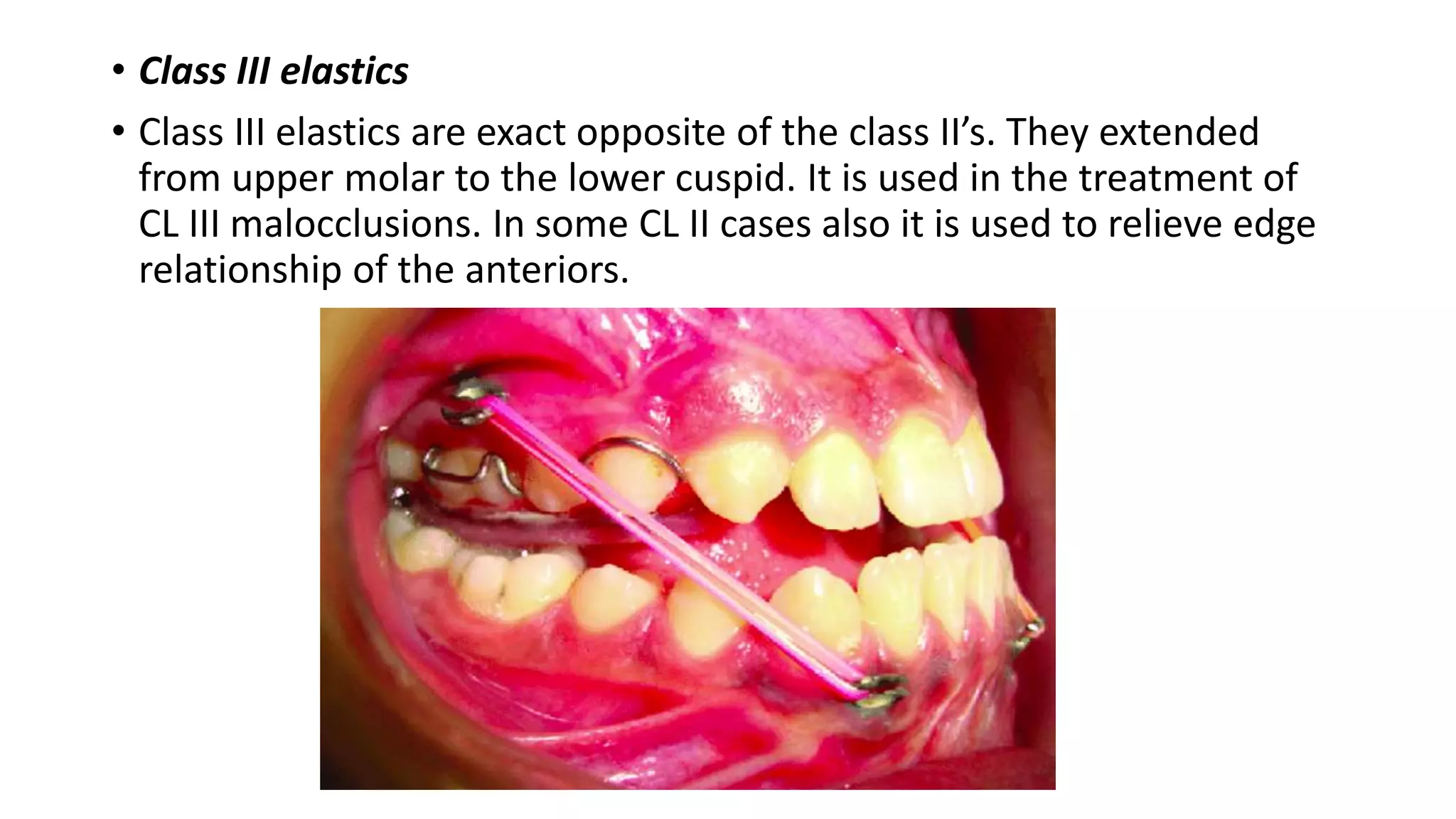 Elastics in Orthodontics -part I | PPTX
