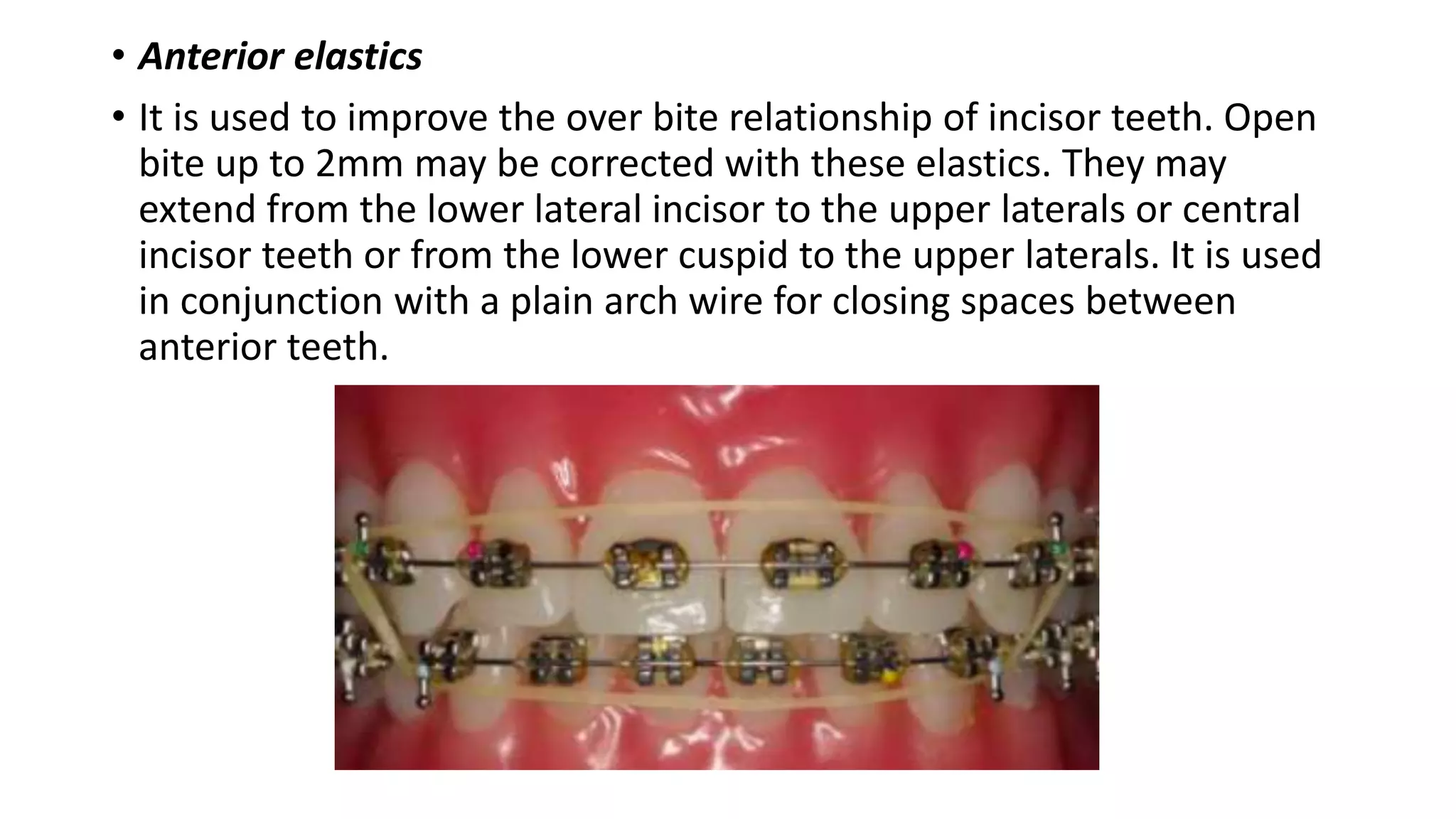 Elastics in Orthodontics -part I | PPTX
