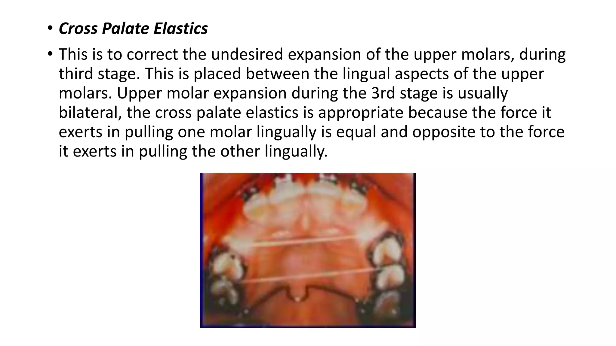 Elastics in Orthodontics -part I | PPTX