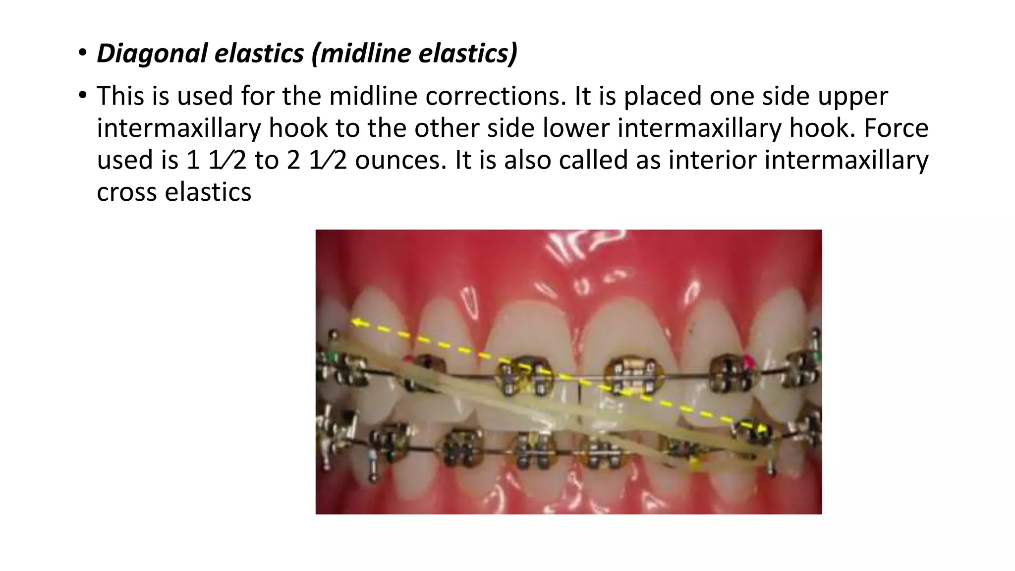 Elastics in Orthodontics -part I | PPTX
