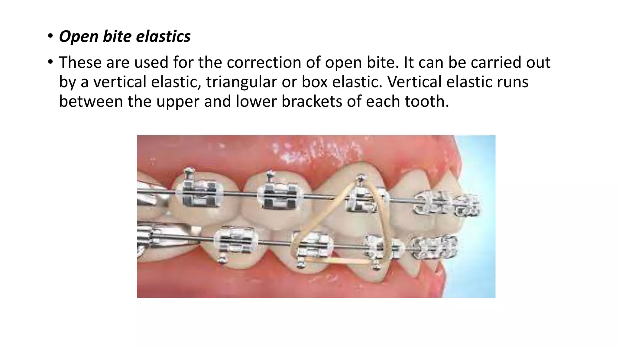 Elastics in Orthodontics -part I | PPTX