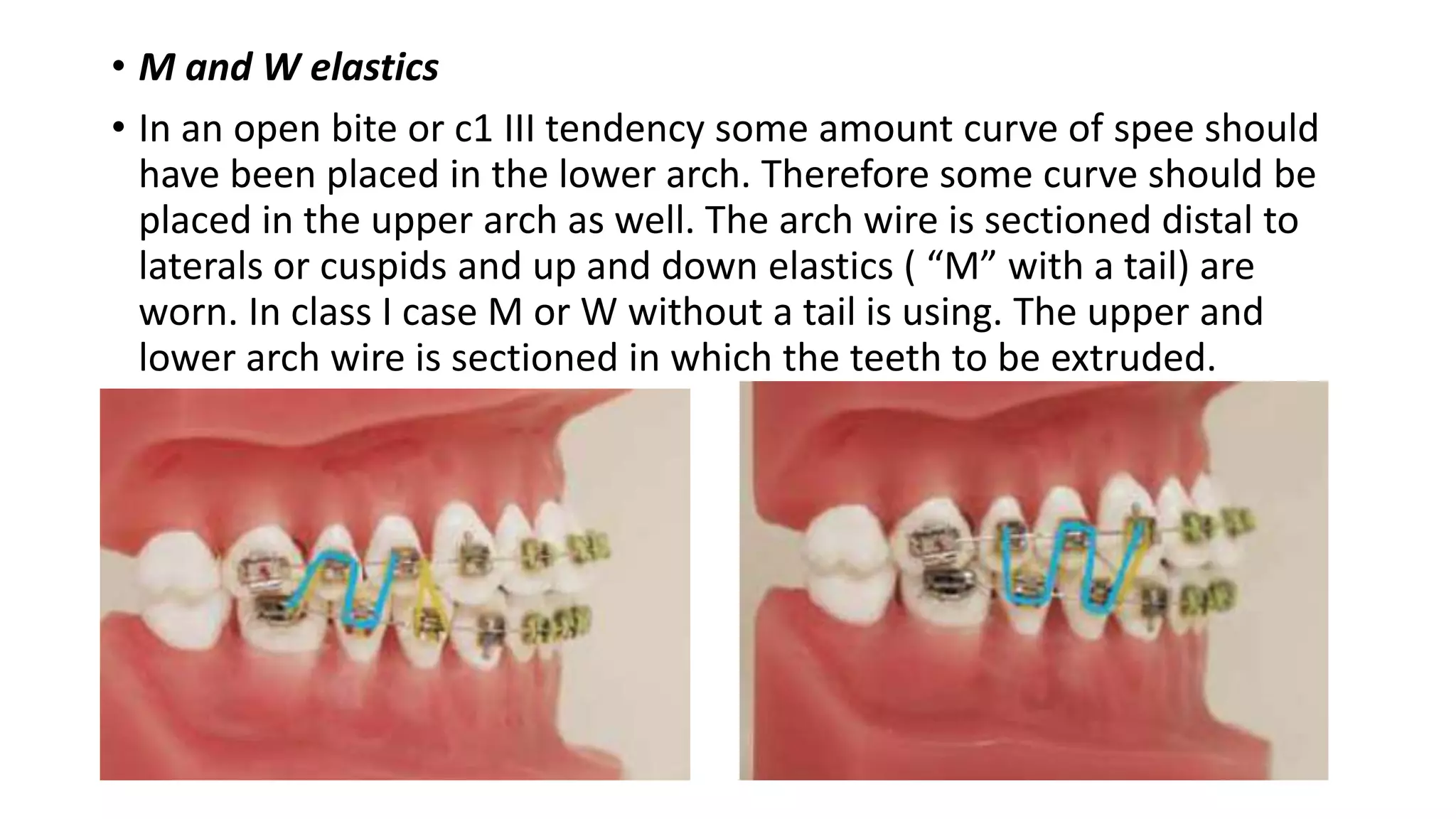 Elastics in Orthodontics -part I | PPTX