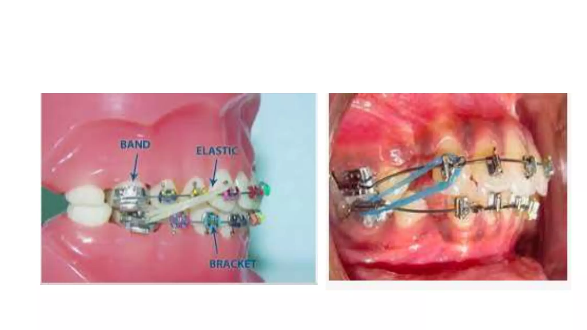 Elastics in Orthodontics -part I | PPTX