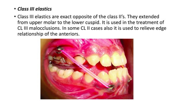 Elastics in Orthodontics -part I | PPTX | Dental Health | Diseases and ...