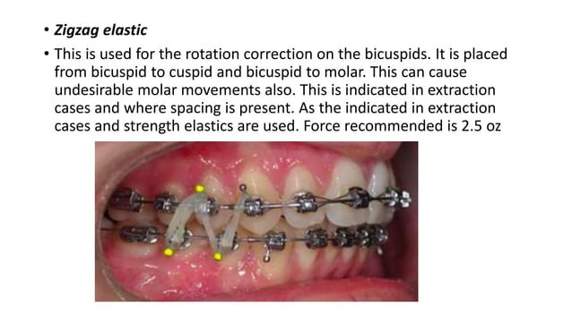 Elastics in Orthodontics -part I | PPTX | Dental Health | Diseases and ...