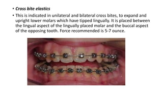 Elastics in Orthodontics -part I | PPTX