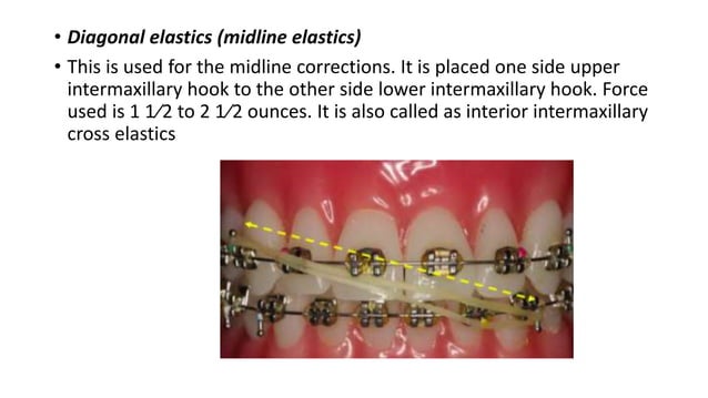 Elastics in Orthodontics -part I | PPTX | Dental Health | Diseases and ...