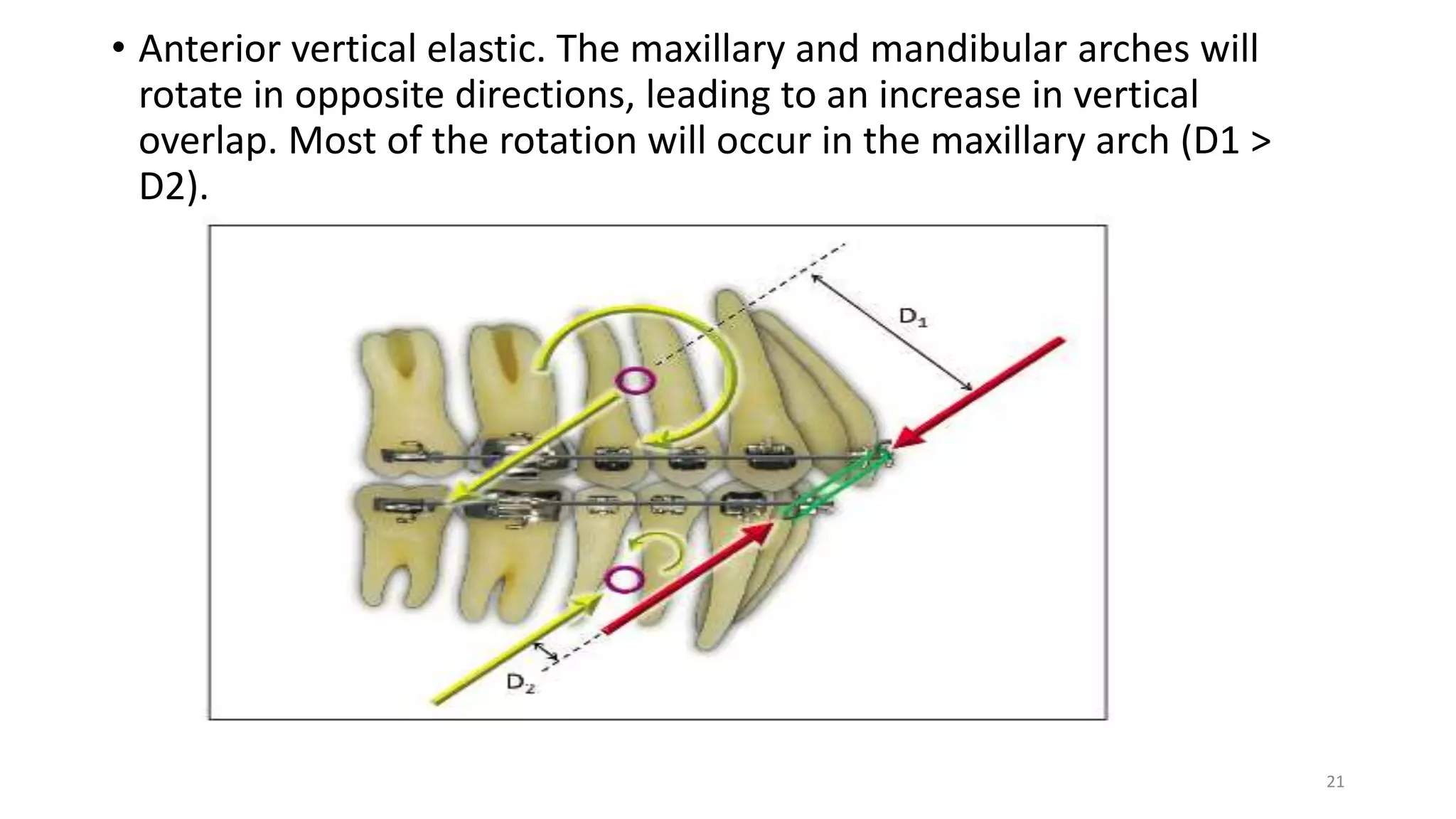 Elastics in Orthodontics-II | PPTX