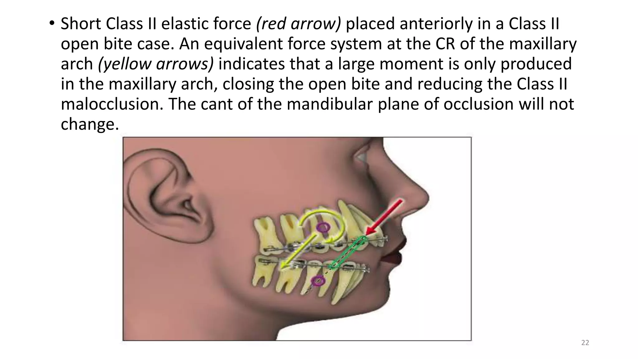 Elastics in Orthodontics-II | PPTX