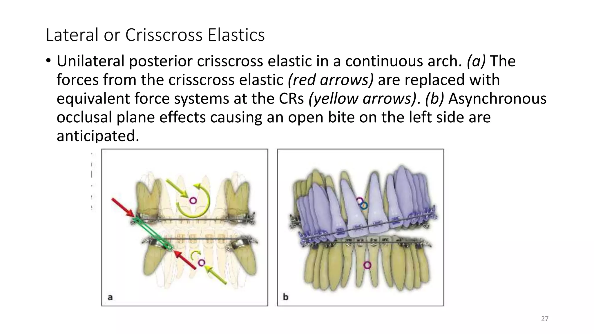 Elastics in Orthodontics-II | PPTX