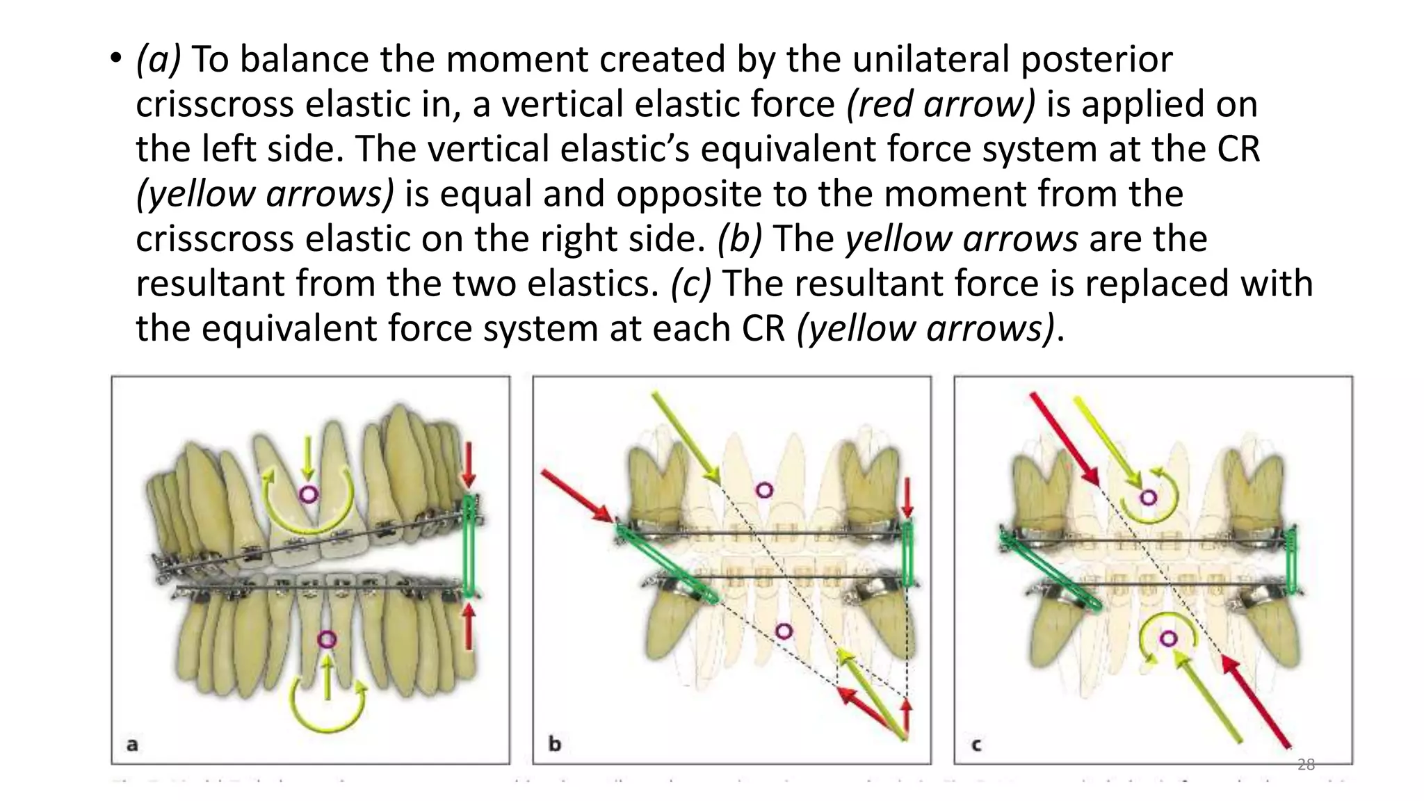 Elastics in Orthodontics-II | PPTX