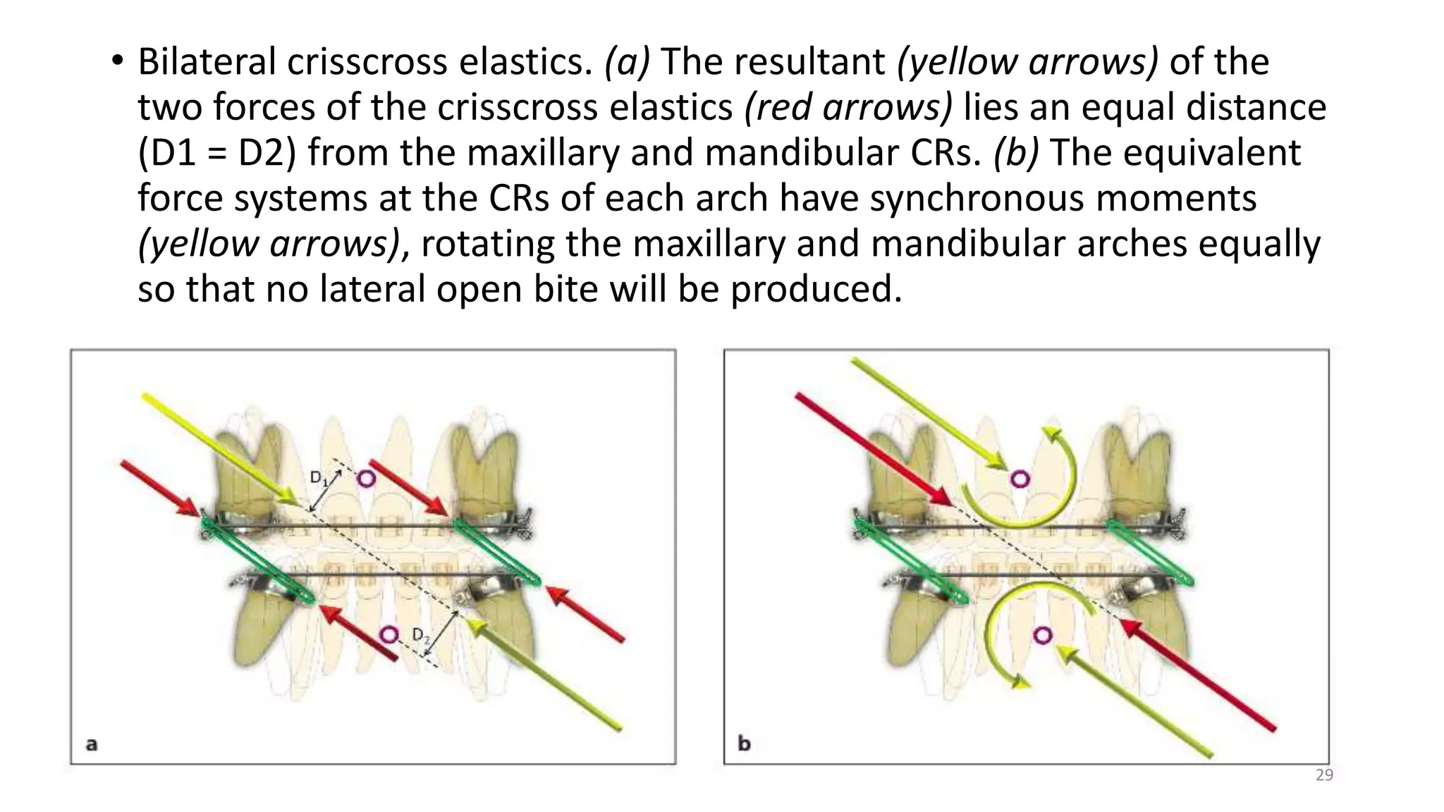 Elastics in Orthodontics-II | PPTX