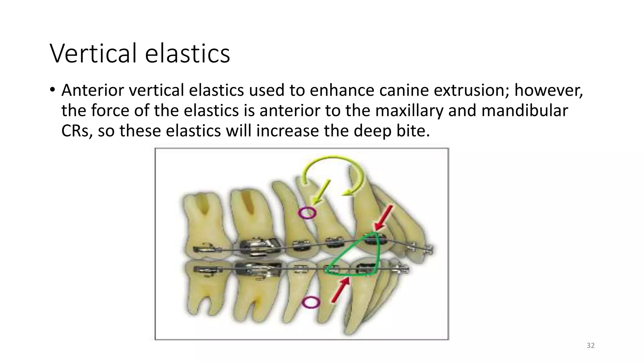 Elastics in Orthodontics-II | PPTX