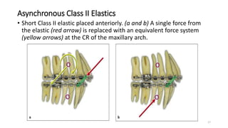 Elastics in Orthodontics-II | PPT