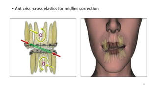 Elastics in Orthodontics-II | PPTX
