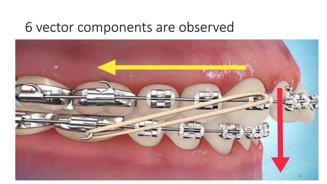 Elastics in Orthodontics-II | PPT