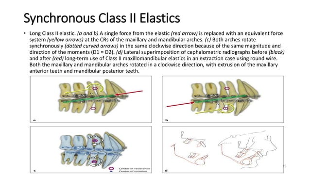 Elastics in Orthodontics-II | PPT