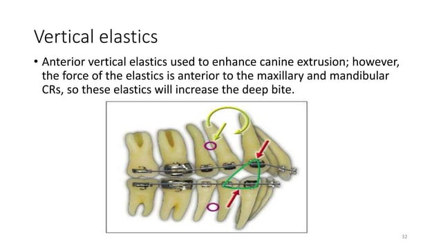 Elastics in Orthodontics-II | PPT