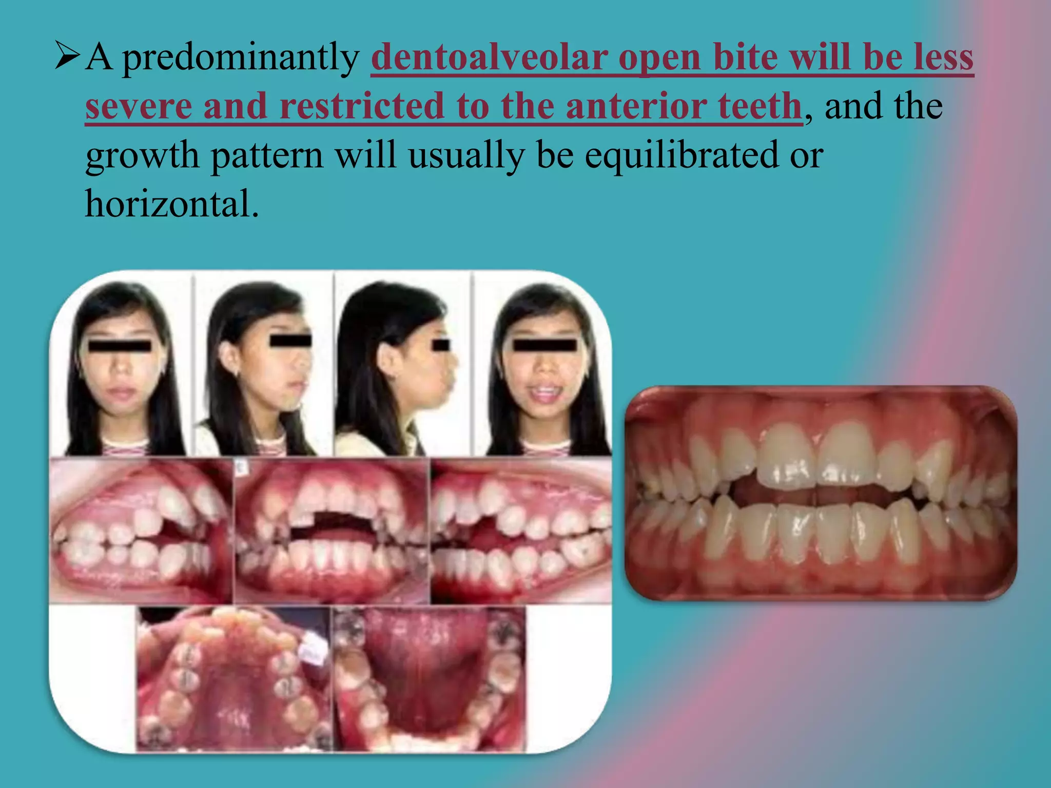 Elastics for open bite treatment | PPTX
